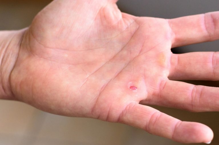 Brandblase aufstechen? Lieber nicht! - So die Brandblase behandeln